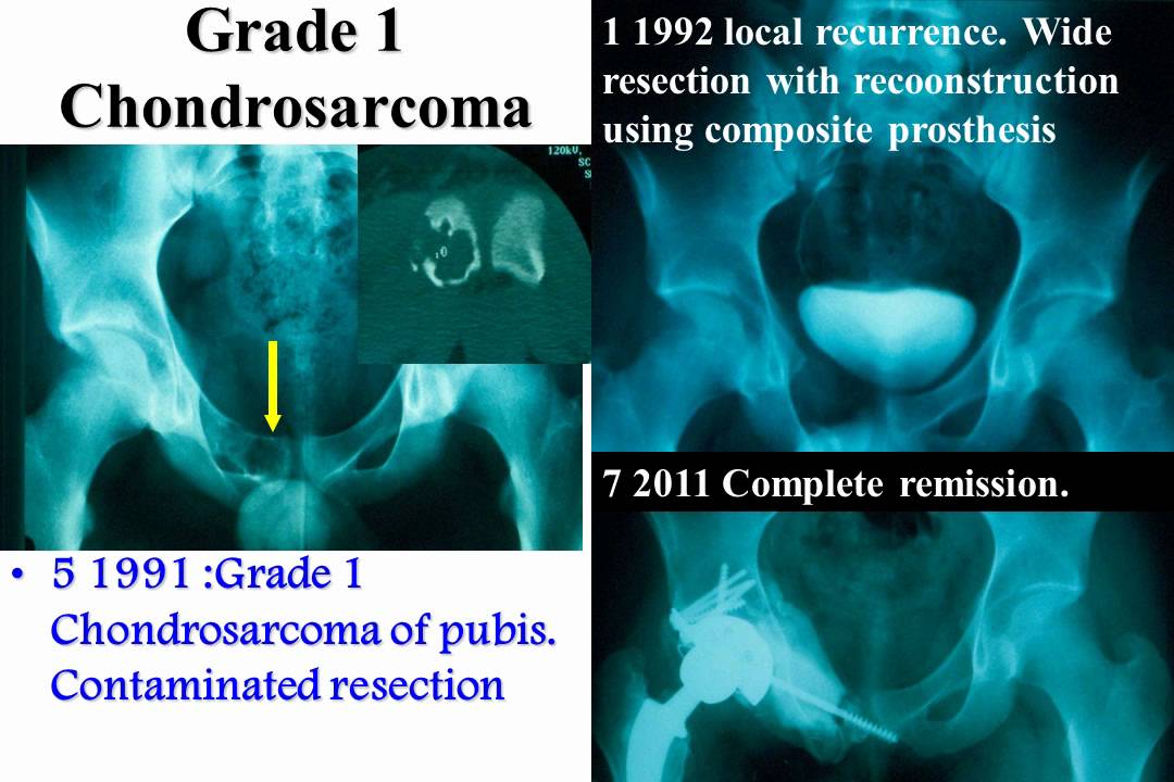 Long term follow up of composite prostheses after periacetabular ...