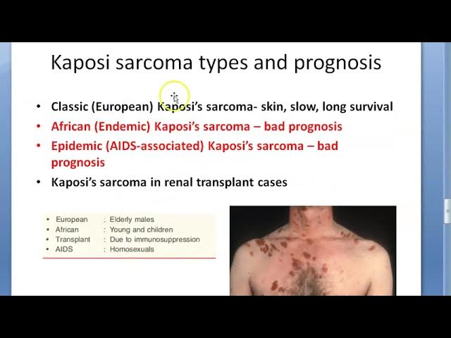 Kaposi Sarcoma Aids