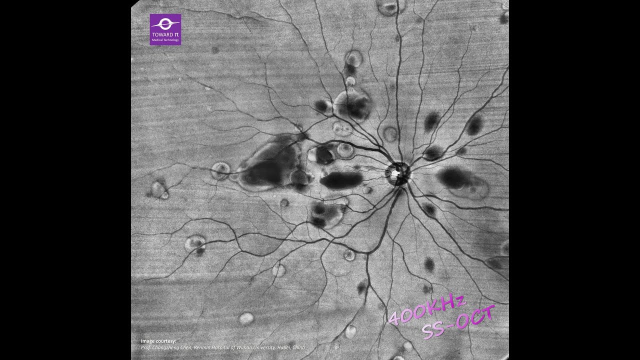 Leukemic multiple retinal hemorrhages, ultra-wide OCT enface image ...