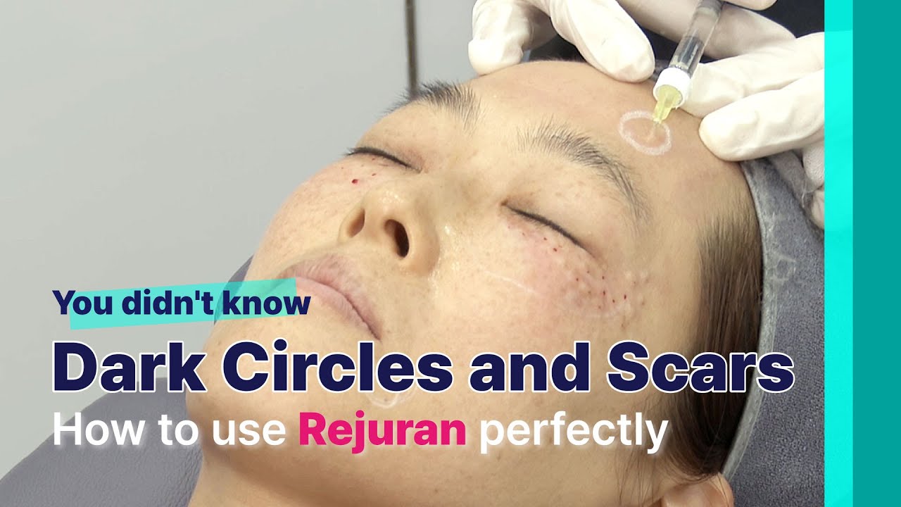 Dark Circles and Scars: How to use Rejuran perfectly - YouTube