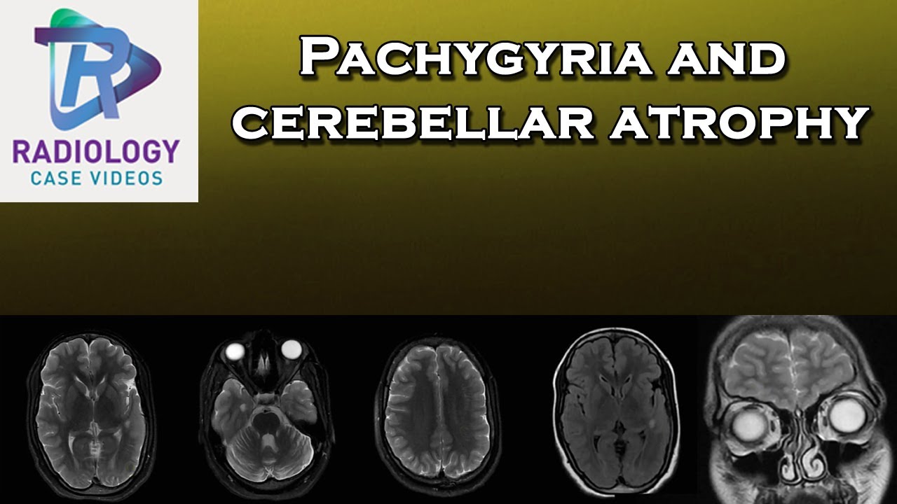Pachygyria and cerebellar atrophy - YouTube