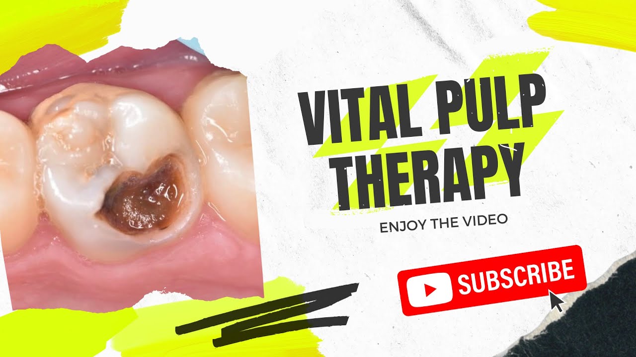 Vital Pulp Therapy - YouTube