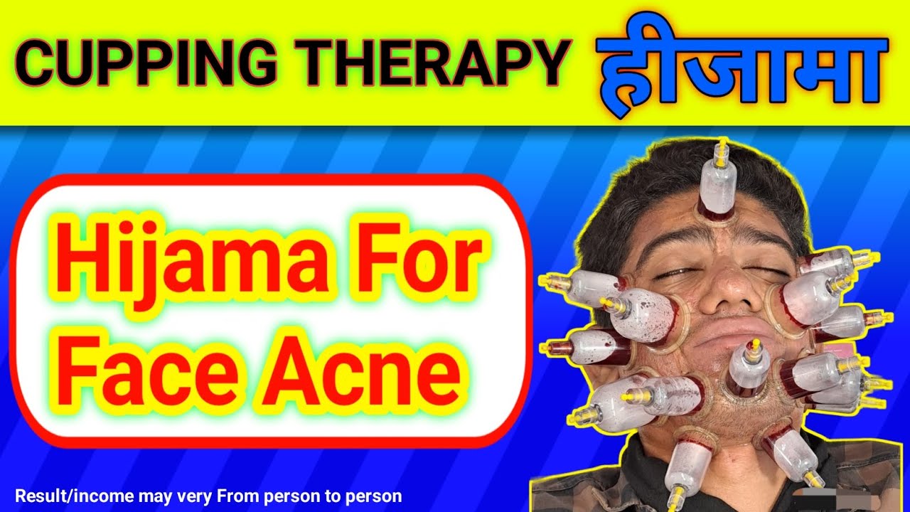 Hijama Acne | Face Hijama For Acne Pimples | Face Hijama Therapy | Acne ...