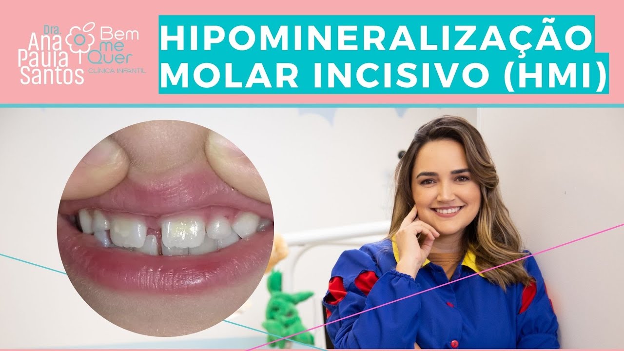 HIPOMINERALIZAÇÃO MOLAR INCISIVO | Dra. Ana Paula - Odontopediatra ...