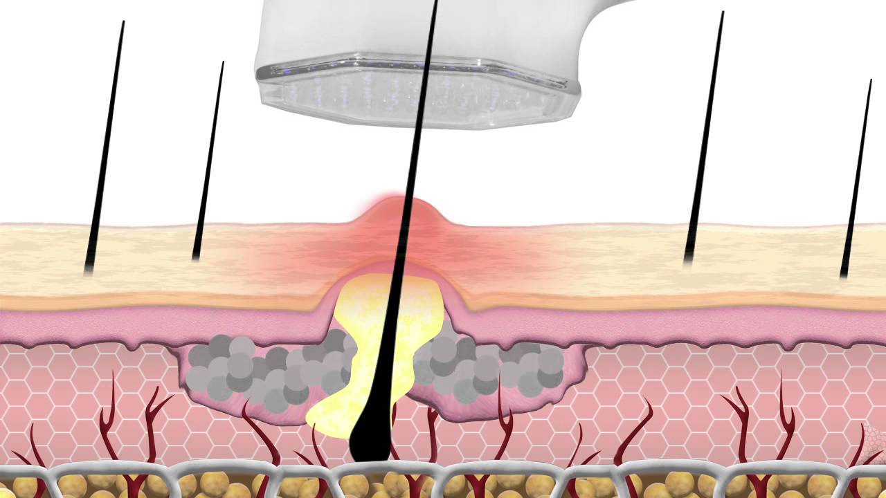 pulsaderm LED Blue Light Acne Treatment - YouTube