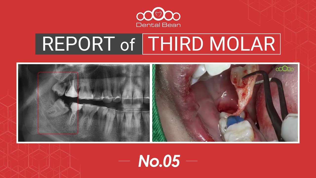 Multisub Extraction Of Mesioangular Rt Mn Third Molar Dr Cho 8240