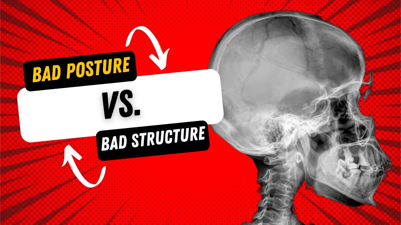 Bad Posture Or Bad Structure - YouTube