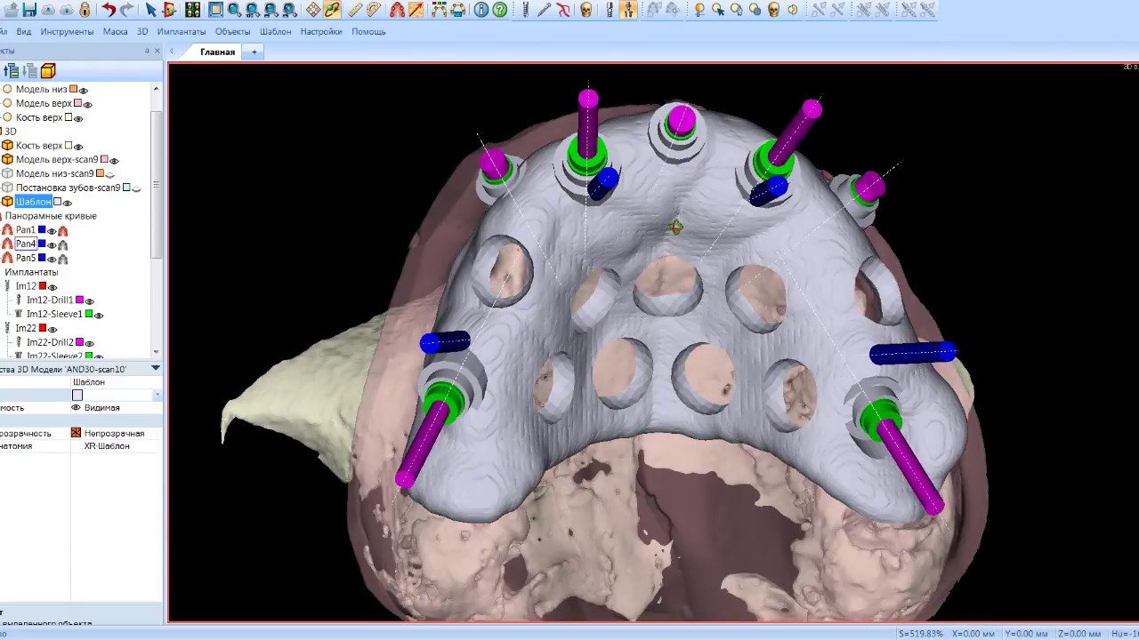 Планирование хирургического шаблона в программе Implant-Assistant - YouTube