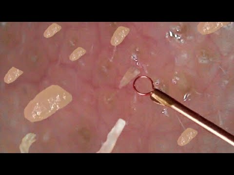 Whiteheads Removal In Ear//Acne Treatment 2022 - YouTube
