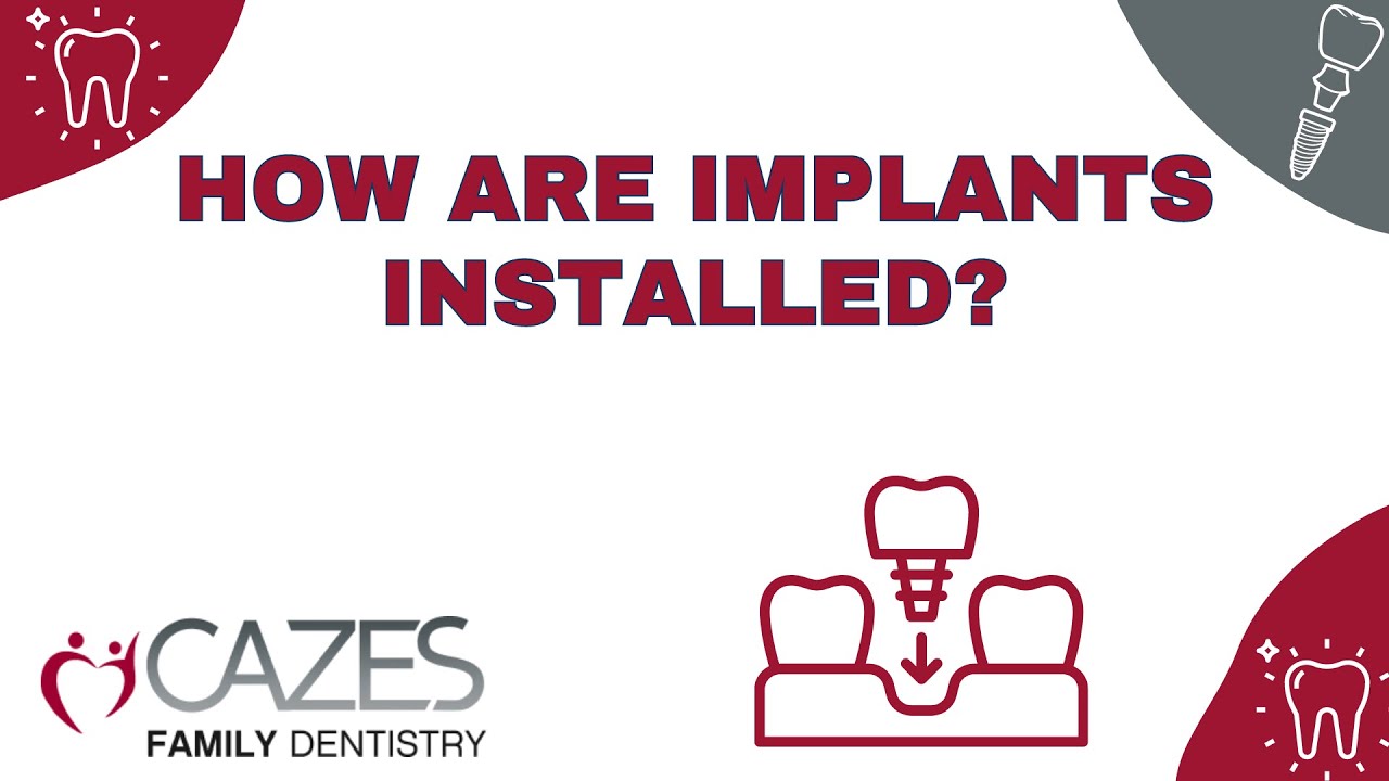 Cazes Family Dentistry - How Are Implants Installed? - YouTube