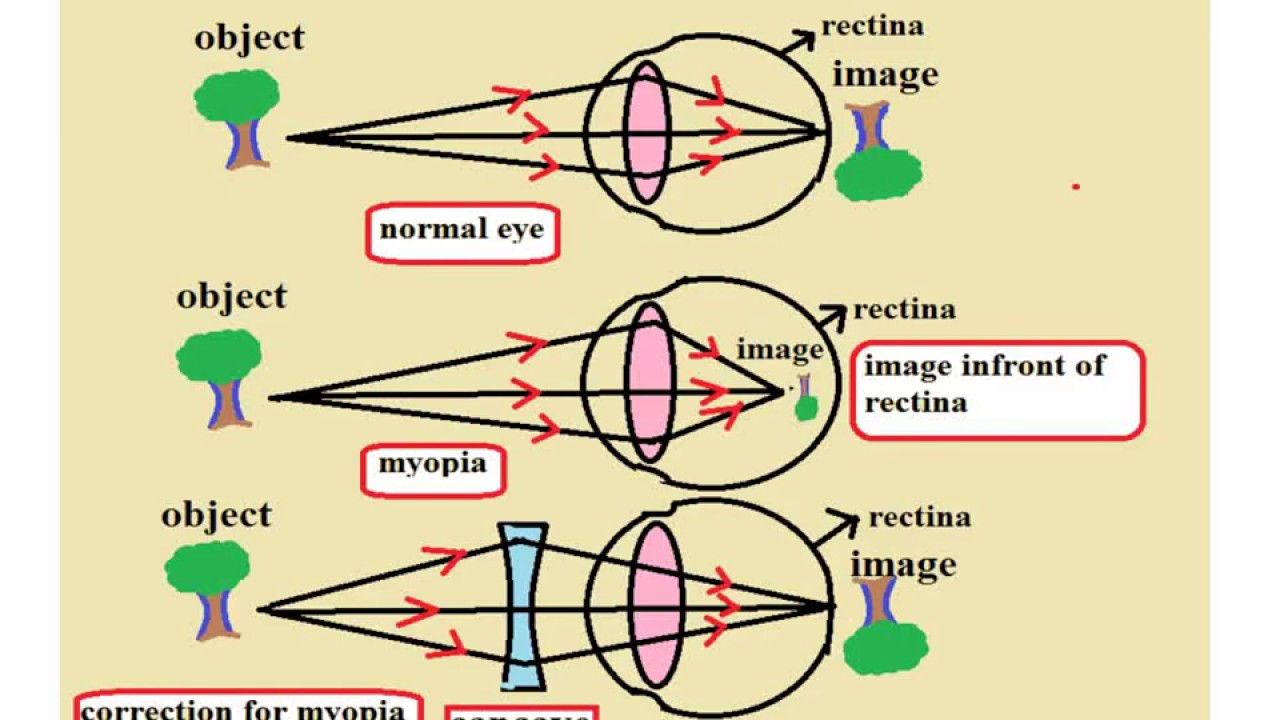 DEFECTS IN EYE - YouTube