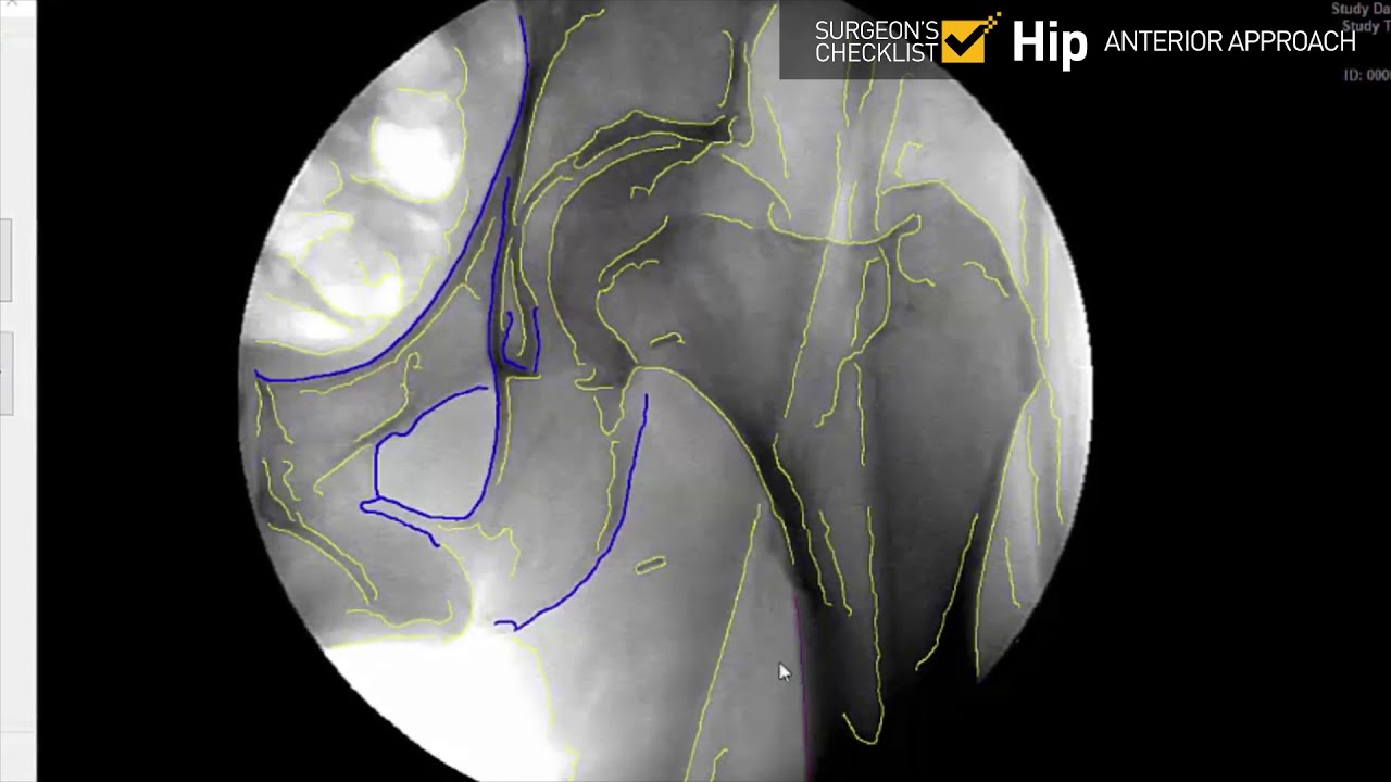 Surgeon's Checklist HIP Anterior Approach Total Hip Arthroplasty - YouTube