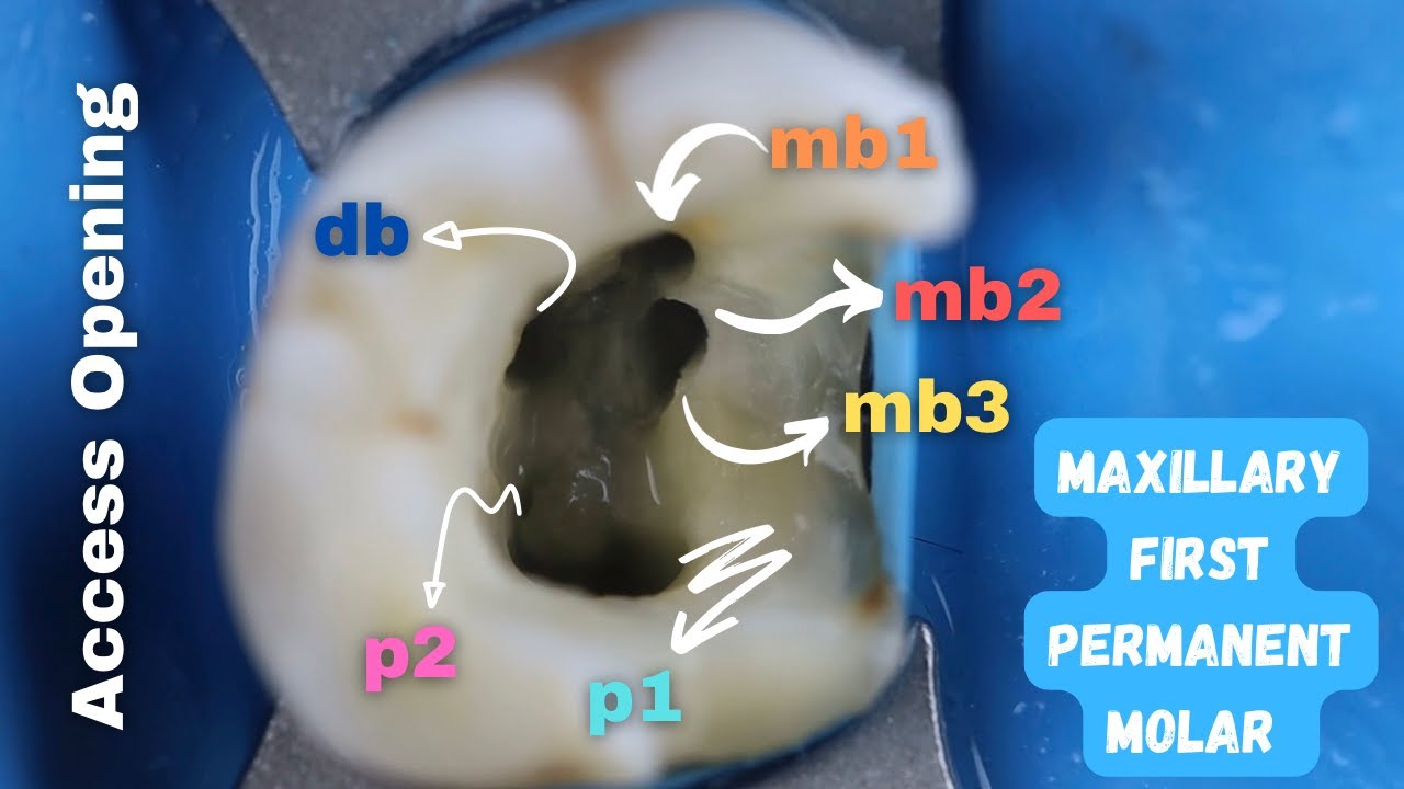 How To Find Mesiobuccal Canals (mb1,mb2,mb3) Easily 🟡 Access Opening ...