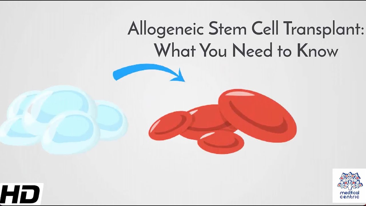 Allogeneic Stem Cell Transplant: What You Need to Know - YouTube