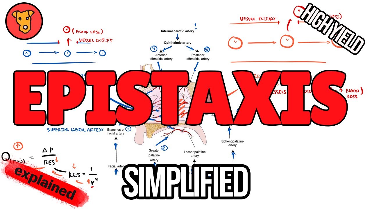Epistaxis (Nosebleed) EXPLAINED: Causes, Management & USMLE High-Yield ...