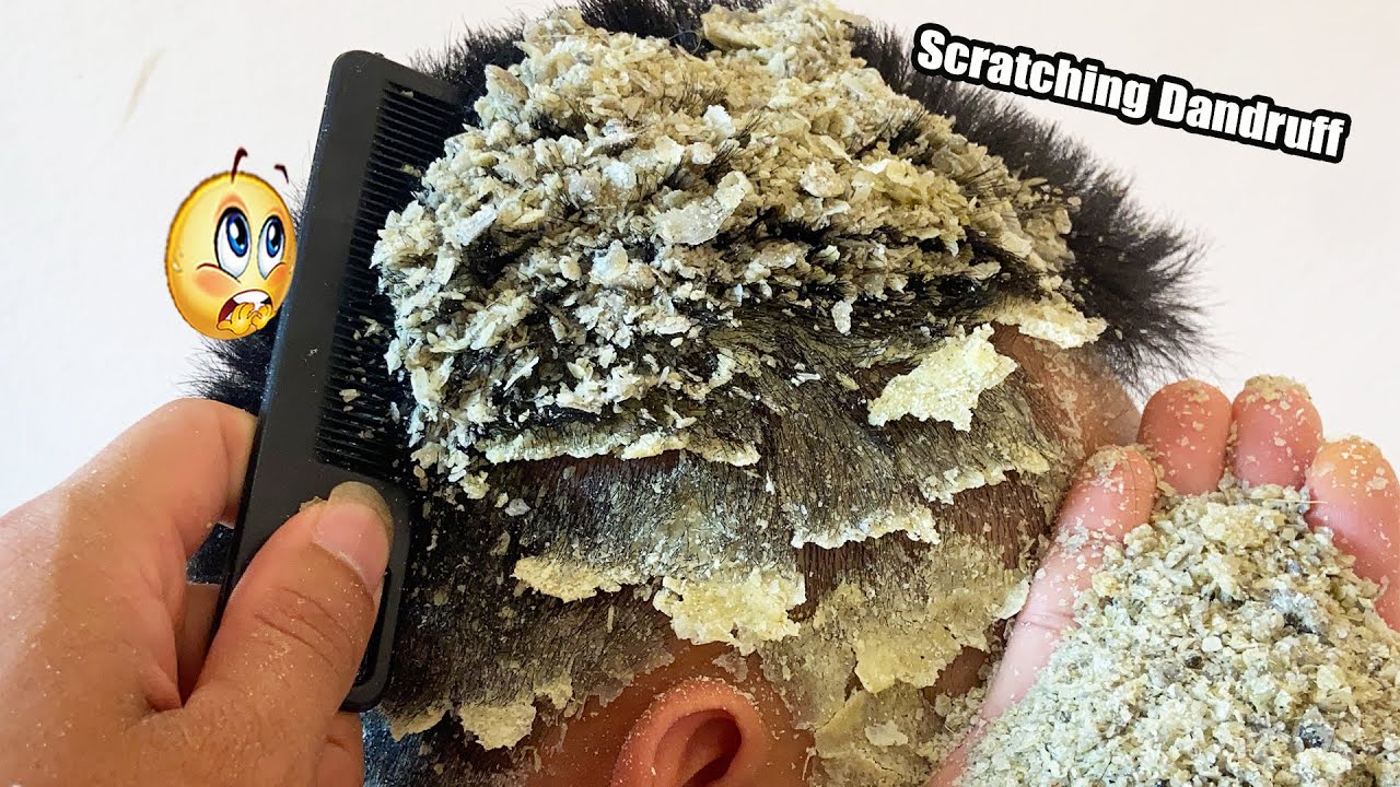 [BOYS DANDRUFF] Itchy psoriasis dandruff Scratching # V118 - YouTube