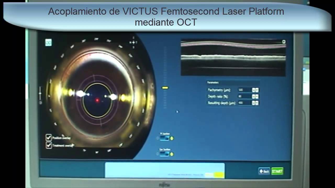 VICTUS Femtosecond Laser Platform for INTACS - YouTube