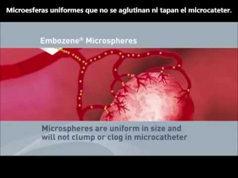 Embolización Uterina con microesferas Embozene (versión corta) - YouTube