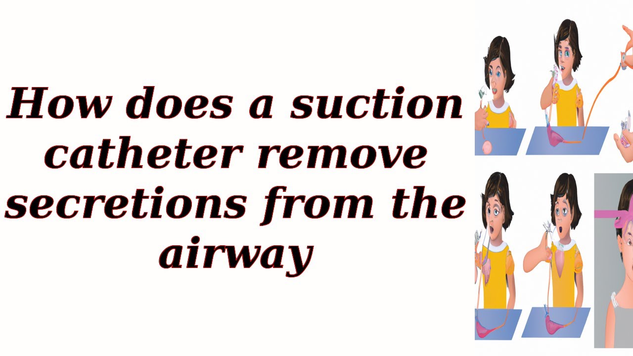 How does a suction catheter remove secretions from the airway? - YouTube