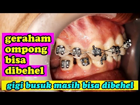 3 bulan, Geraham ompong & gigi berantakan yang dibehel, gigi busuk gusi ...