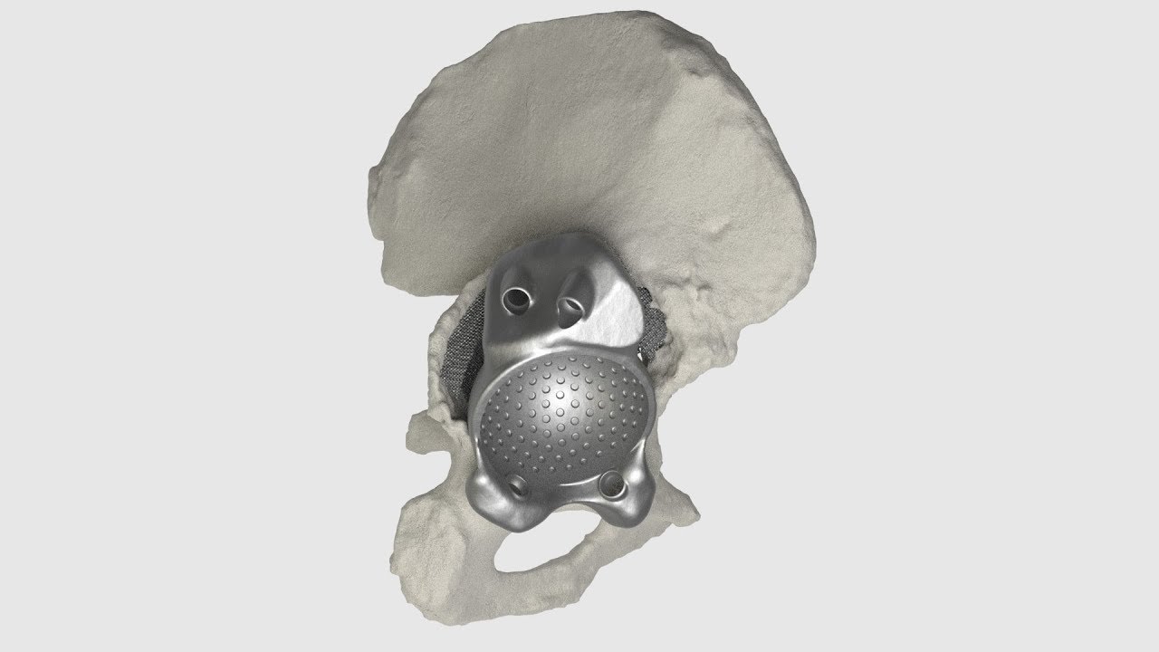 PME Planner - Flanged acetabular cup with augment - YouTube