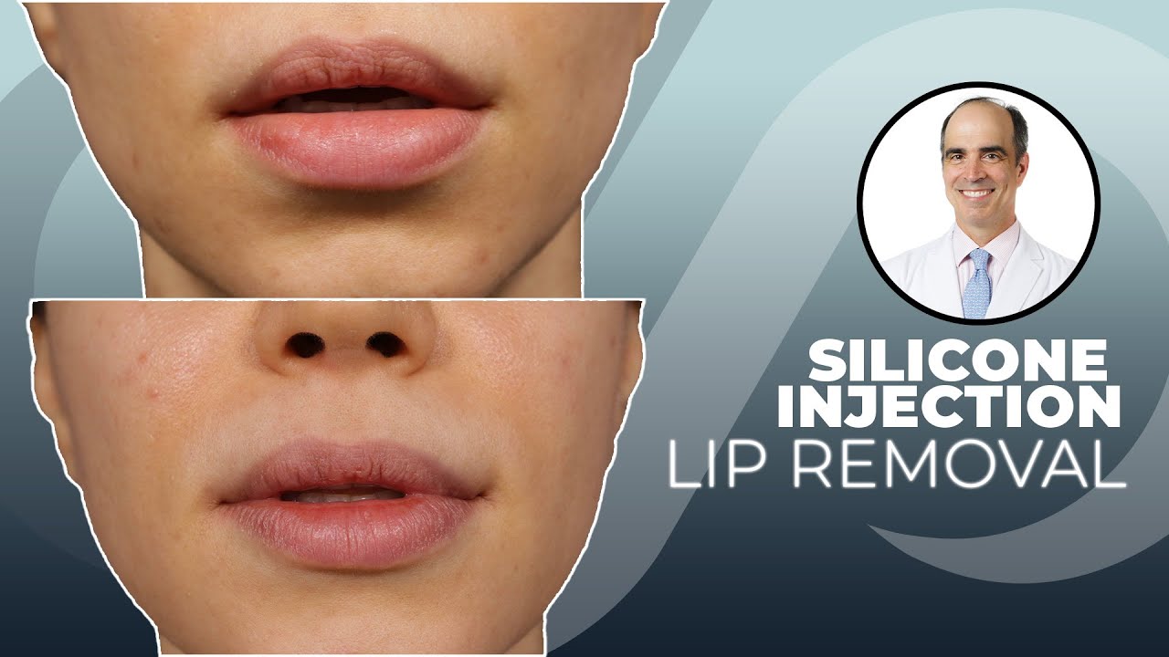 Remove Silicone Lip Injections Safely - Dr. David Stoker - YouTube