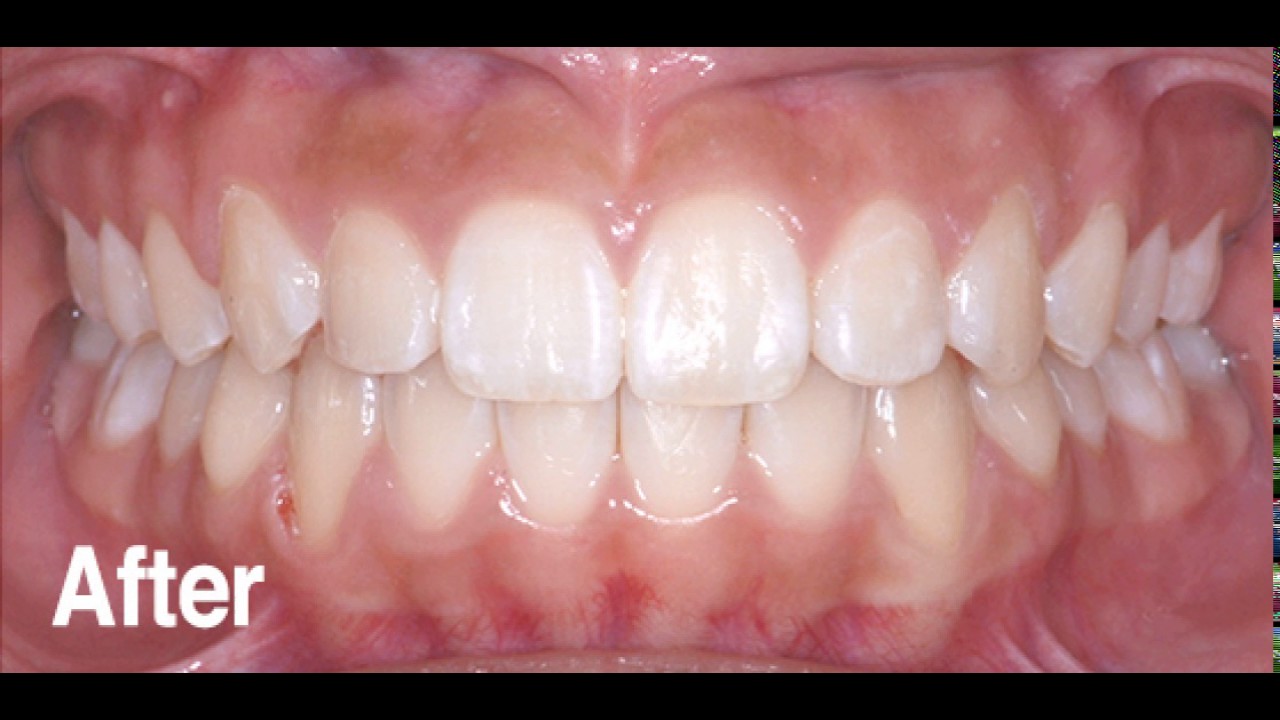 Before and After Accelerated Invisalign Pictures Morph in Atlanta - YouTube