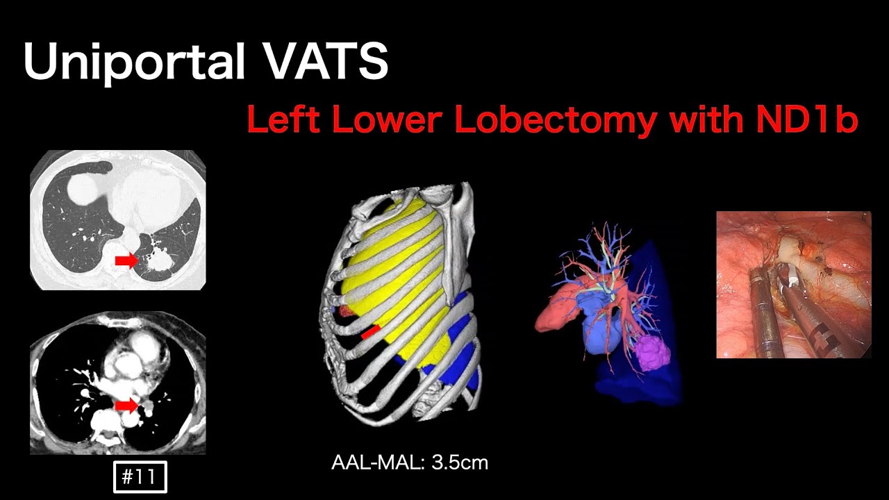 123】Uniportal VATS left lower lobectomy with ND1b for 86 y.o patient ...