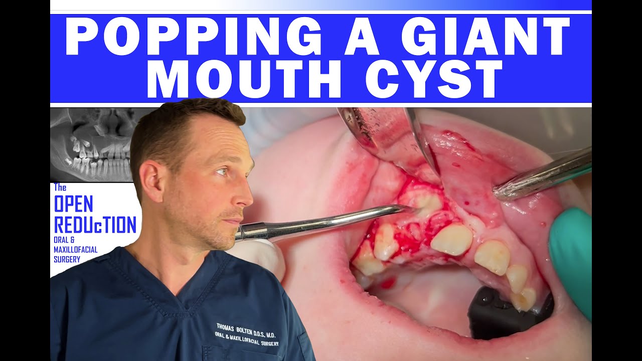 POPPING a GIANT MOUTH CYST | #cystpoping - YouTube