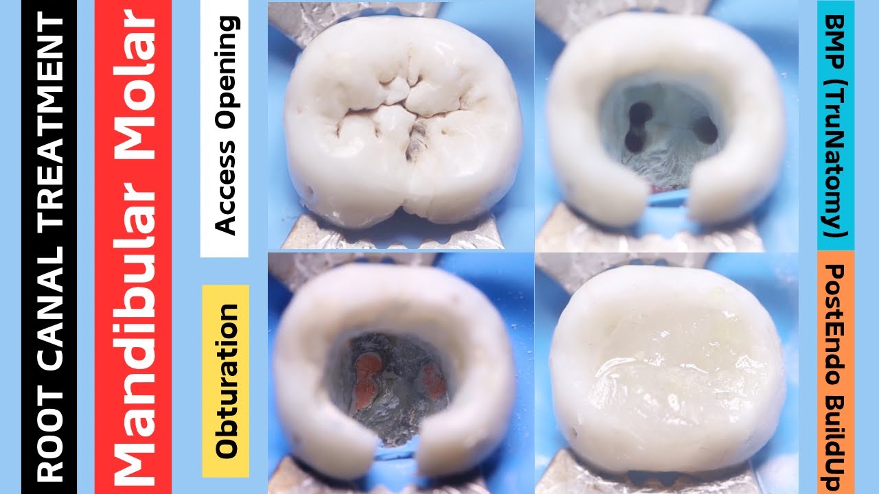Root Canal Treatment 🔵 Mandibular Molar 🟡Access Opening🟢Biomechanical ...