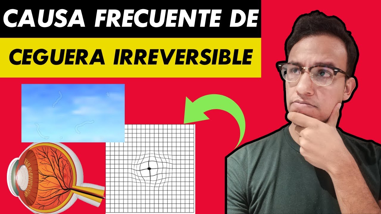 DEGENERACIÓN MACULAR - primera causa de ceguera NO REVERSIBLE - YouTube