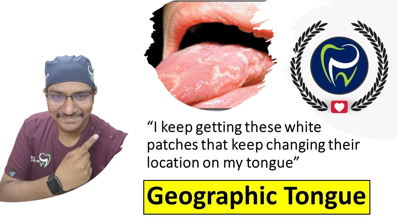 Dr Rudra Mohan |White spots on my tongue that keep changing Location ...
