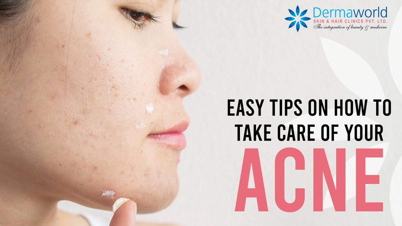 Easy tips on how to take care of your acne | Dr. Rohit Batra ...