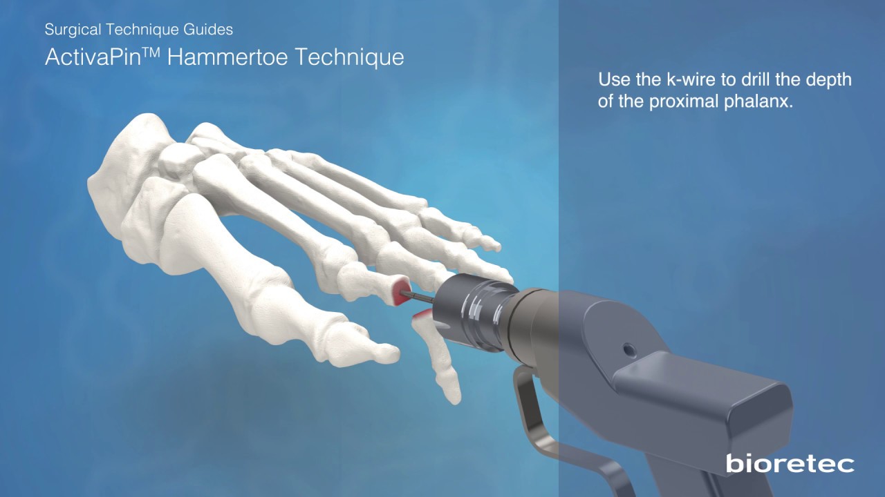 Bioretec ActivaPin™ Hammertoe Technique - YouTube