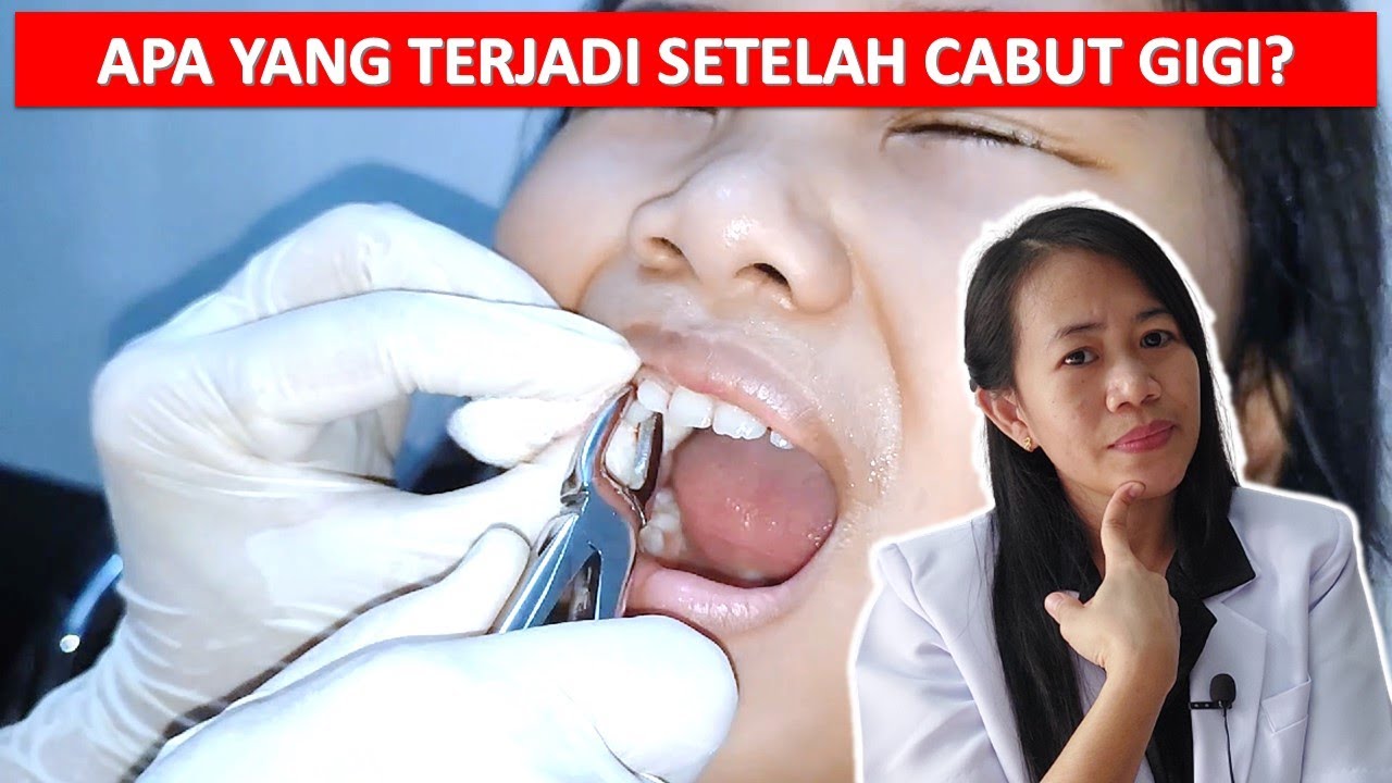 Apa yang terjadi setelah cabut gigi ? Begini tahapan penyembuhan setelah cabut gigi - YouTube