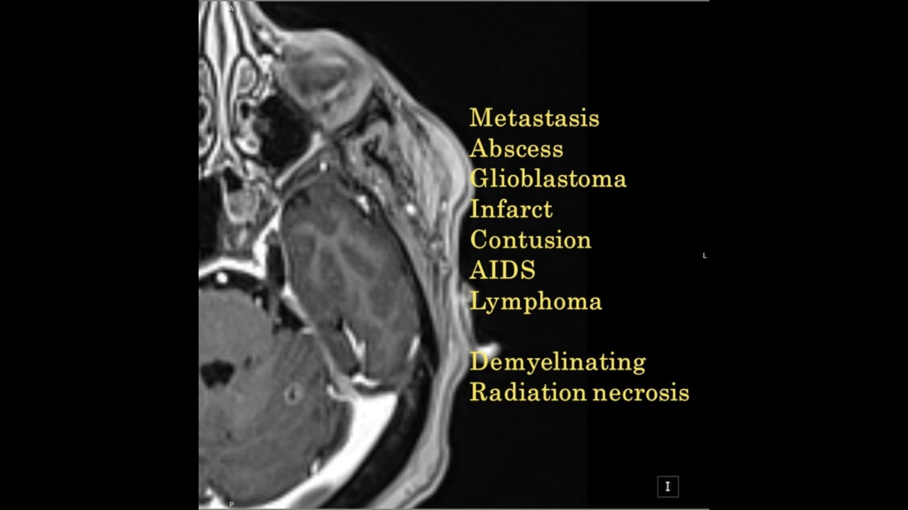 Cerebral ring enhancing lesions - MAGICAL DR - YouTube