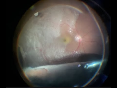 GRT Detachment and FTMH Repair - YouTube