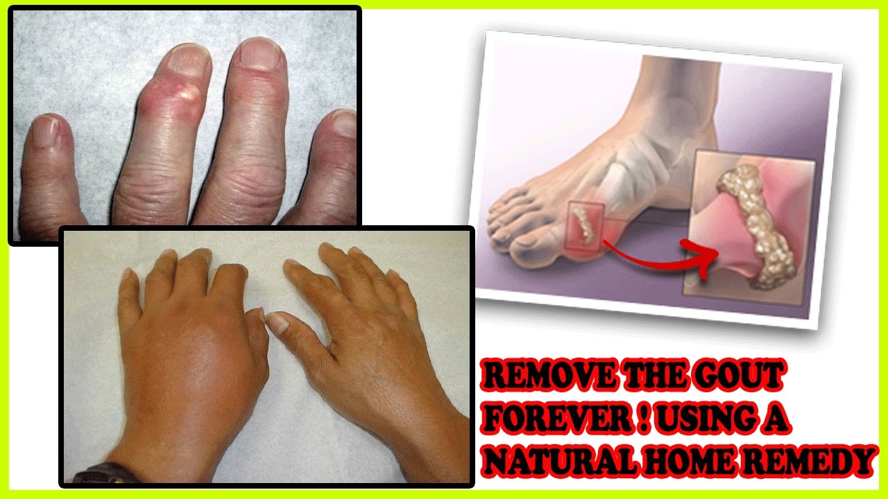 Remove The Gout Forever Using A Natural Home Remedy Youtube