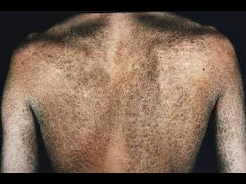 How To Treat And Cure Ichthyosis Vulgaris - YouTube