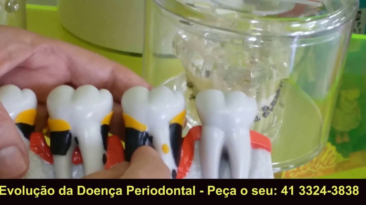 Evolução da Doença Periodontal com compromentimento de Furca - YouTube