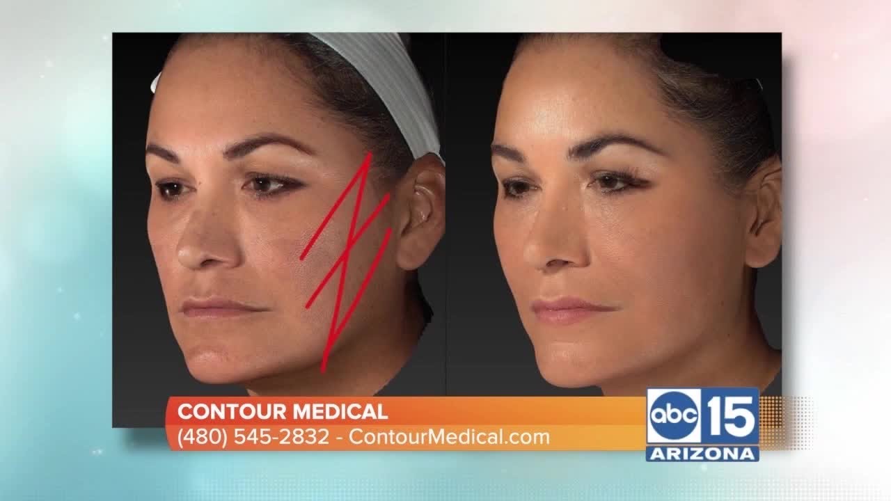 Contour Medical can give you a facelift without having surgery! - YouTube