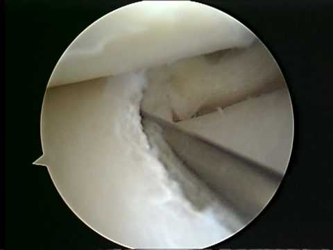 Meniscus cyst decompression - YouTube