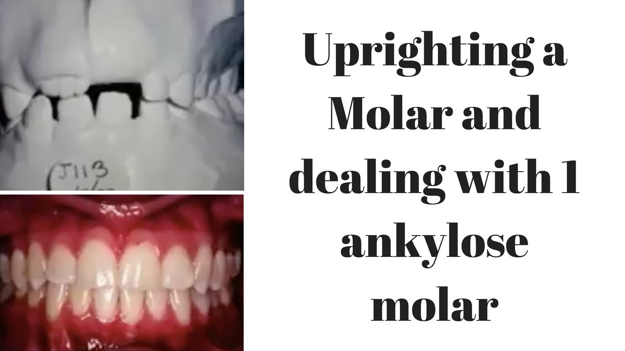 Uprighting a Molar and dealing with 1 ankylose molar - YouTube