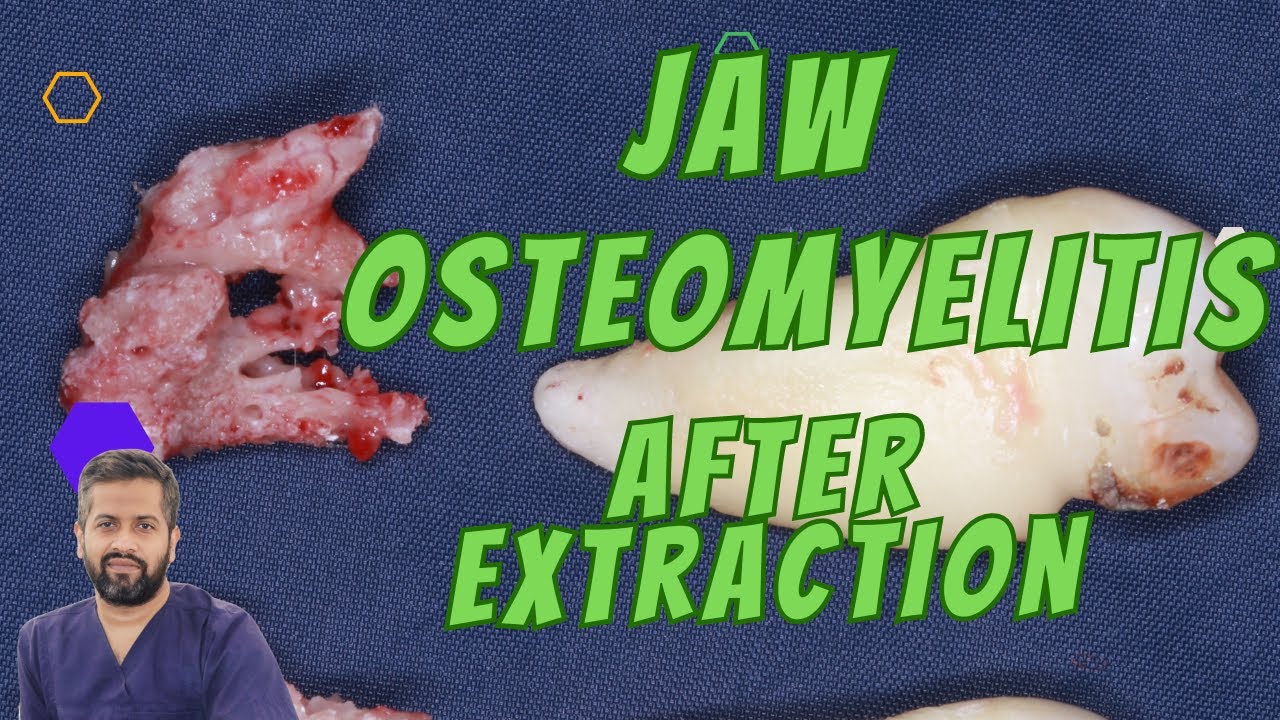 OSTEOMYELITIS OF MANDIBLE AFTER EXTRACTION - YouTube