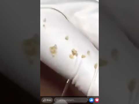 How to properly care for Blackheads Whiteheads | Acne popping | Pimple ...