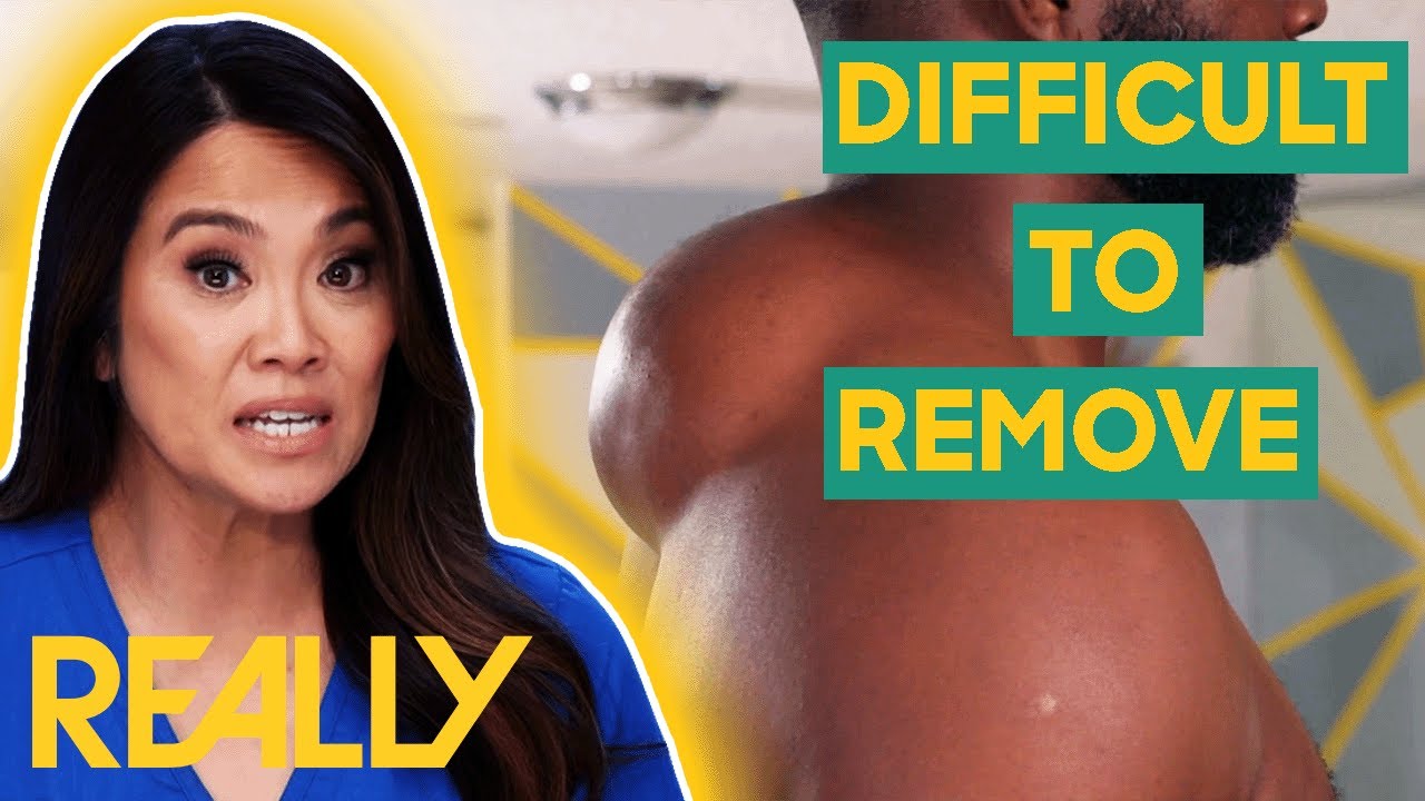 Dr. Lee Faces Challenge Removing Patient's "Hunchback" | Dr. Pimple ...