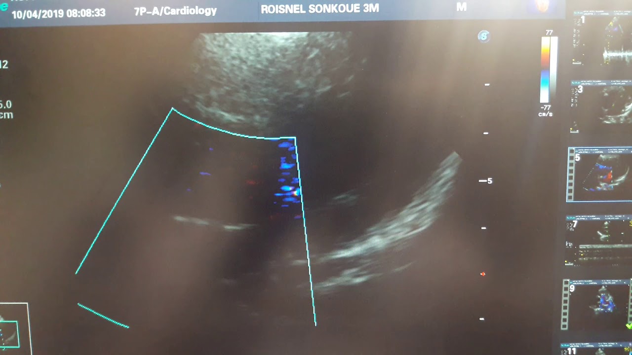 Patent foramen ovale in a 7 months old child - YouTube