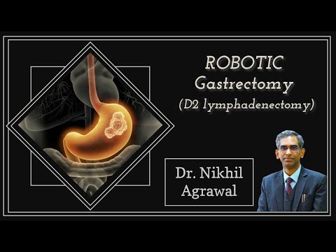 Robotic Subtotal Gastrectomy with D2 Lymphadenectomy for Gastric Cancer ...