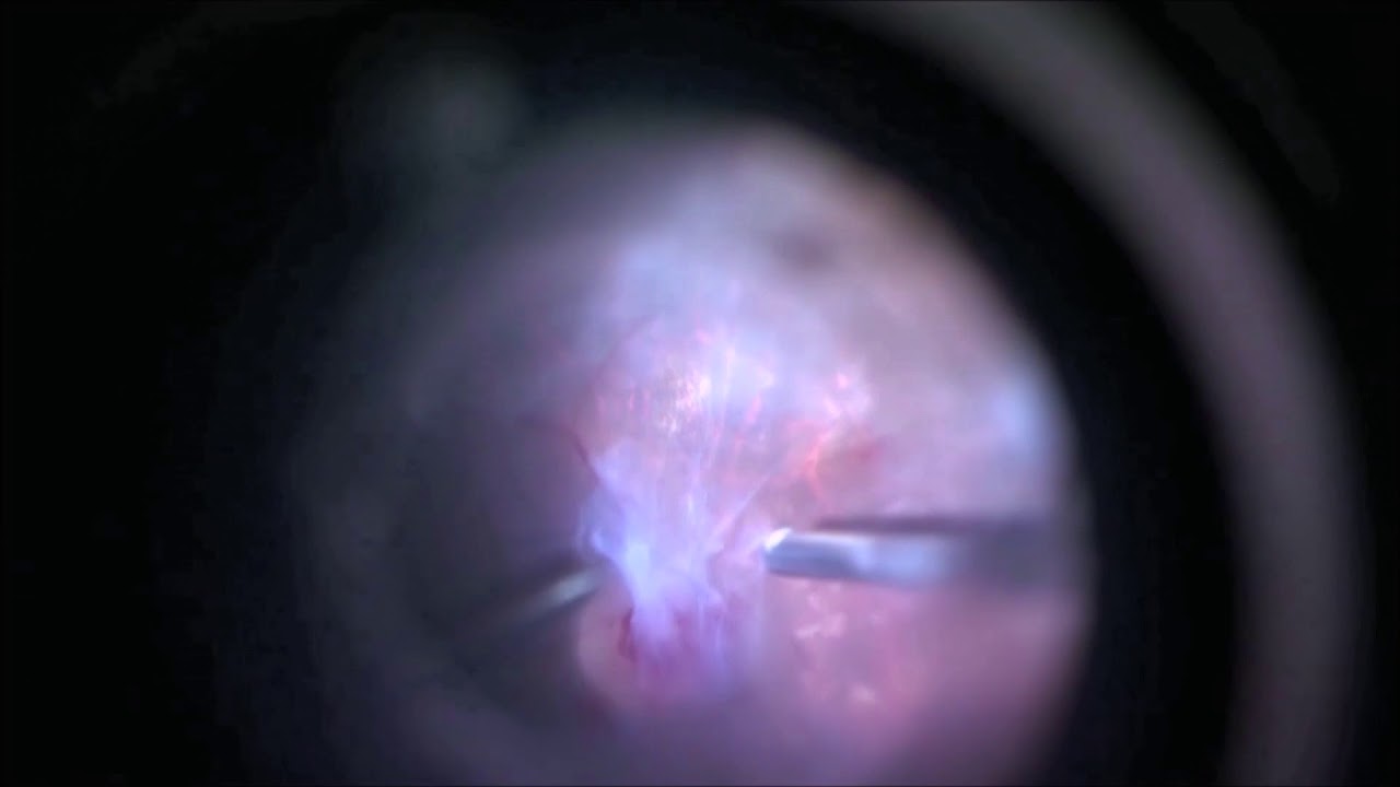 AIOC2018 - VT35 - Managing Vitreo-Retinal Interface in Diabetic ...