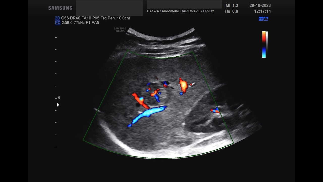 iperplasia nodulare focale (FNH) - YouTube